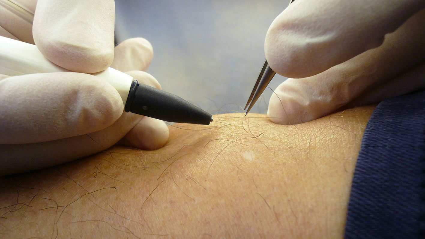 Elektro-Epilation - Fachverband Elektrologie e. V.