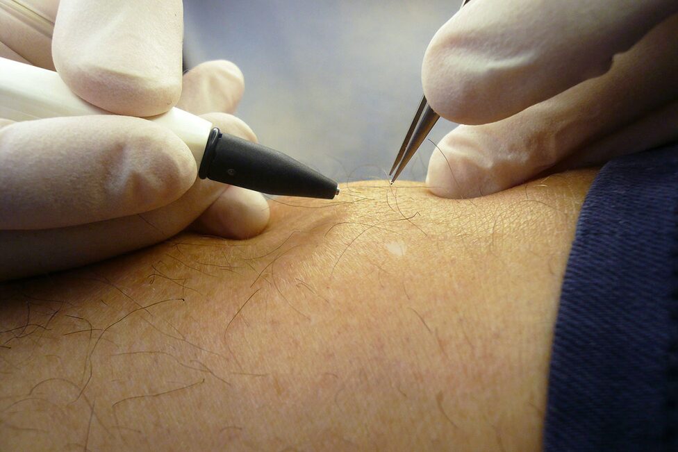 Elektro-Epilation - Fachverband Elektrologie e. V.